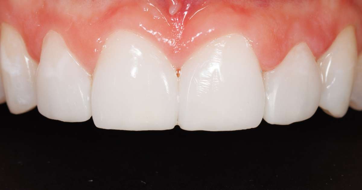 Composite Bonding vs Edge Bonding // The Modern Dentist Shoreditch, London